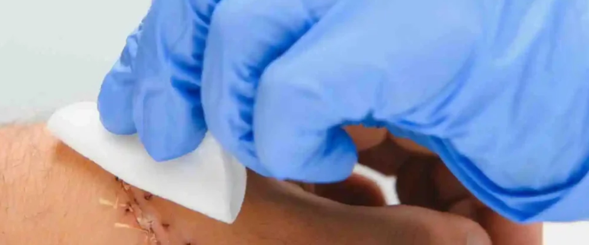 Mastering The Technique Of How To Cauterize A Wound For Chronic Wound ...