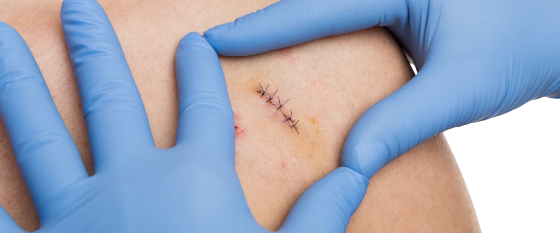 Dissolvable Stitches Healing Stages: How to Heal Faster & Safer