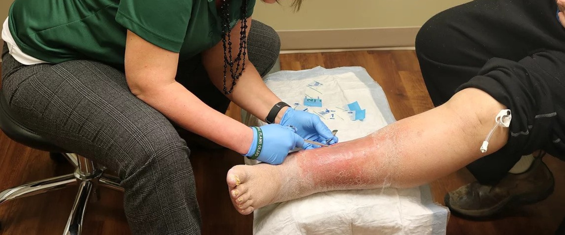 Excoriation Wound Care: Causes, Symptoms, and Expert-Recommended ...